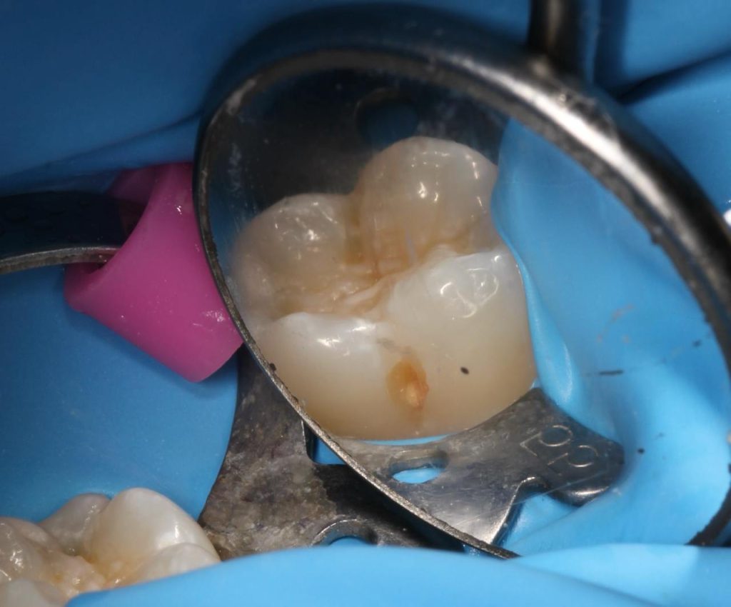 Treatment of Permanent Molar Decay in an 8-Year-Old Child | DentalDate ...